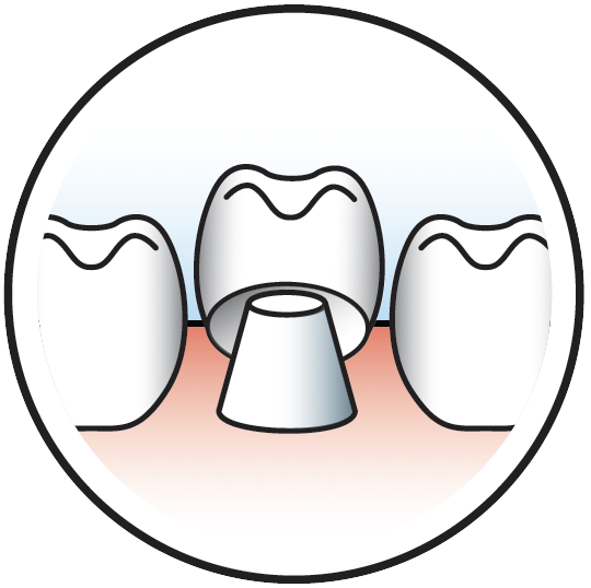 Riva Cem Automix | Cimento de Ionômero de vidro modificado por resina ...